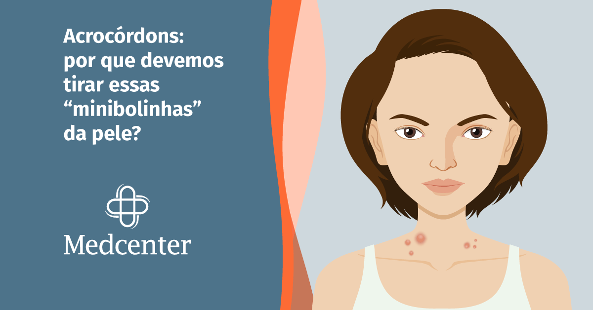 Acrocórdons: por que devemos tirar essas “miniverruginhas” da pele ...