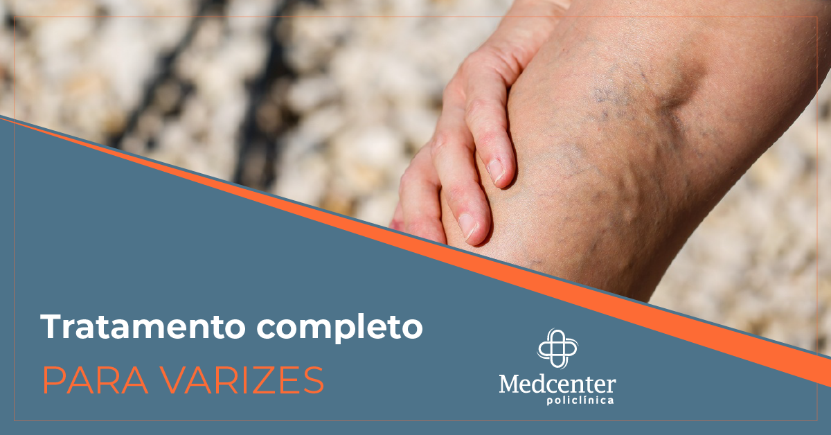 Quais são as terapias mais apropriadas para curar varizes? Entenda ...